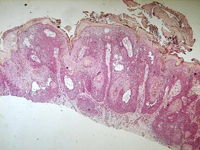 Gottron’s papules-like eruption developing under hydroxyurea therapy ...