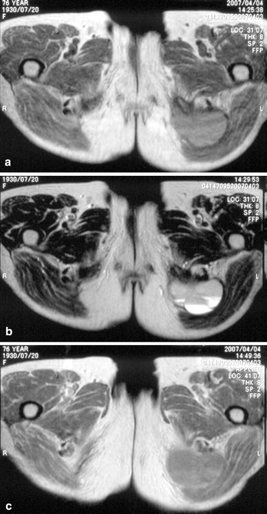 Ischiogluteal bursitis: a report of three cases with MR findings ...
