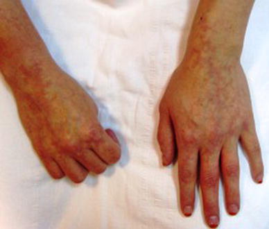 A rarely seen syndrome in rehabilitation of hemiplegia ...