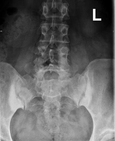 Osteitis Condensans Ilii | SpringerLink