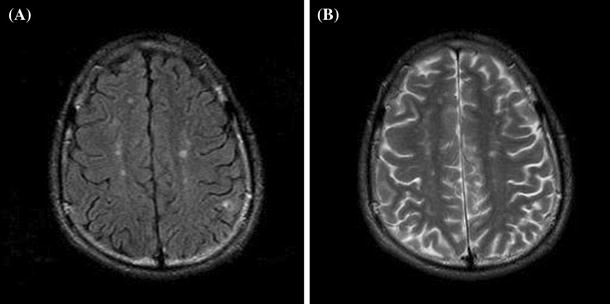 Brain MRI in neuropsychiatric lupus: associations with the 1999 ACR ...