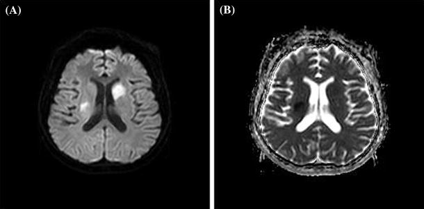 Brain MRI in neuropsychiatric lupus: associations with the 1999 ACR ...