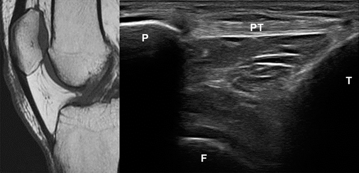 Sonographic characterization of Hoffa’s fat pad. A pilot study ...