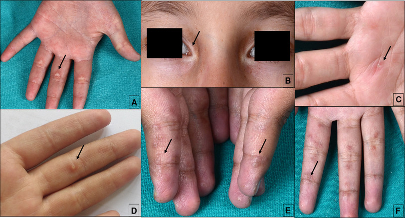 Inverse Gottron papules in juvenile dermatomyositis: an under ...