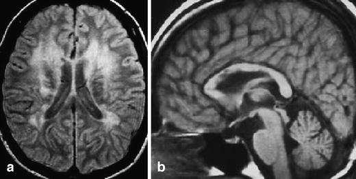 Acquired lesions of the corpus callosum: MR imaging | SpringerLink