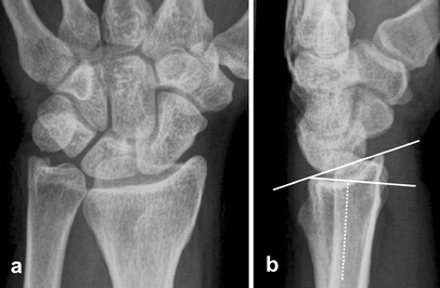 Carpal instability | SpringerLink