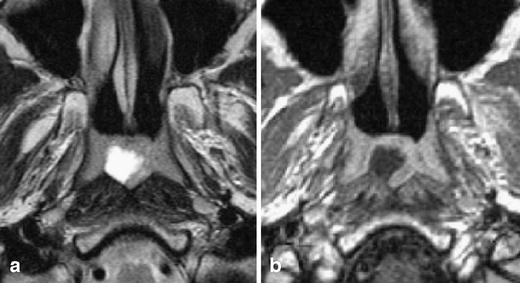 Imaging of nasopharyngeal cysts and bursae | SpringerLink