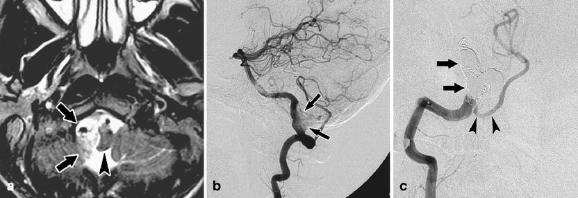 Dissection of the V4 segment of the vertebral artery: clinicoradiologic ...