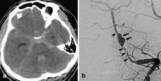Dissection of the V4 segment of the vertebral artery: clinicoradiologic ...