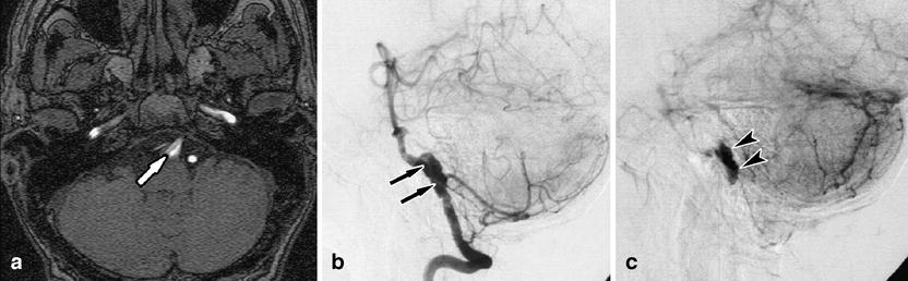 Dissection of the V4 segment of the vertebral artery: clinicoradiologic ...