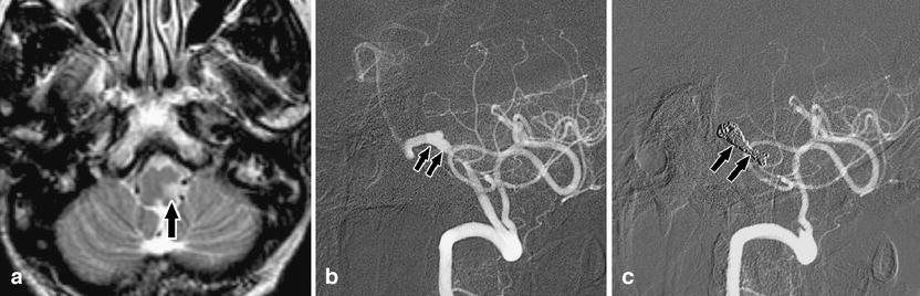 Dissection of the V4 segment of the vertebral artery: clinicoradiologic ...