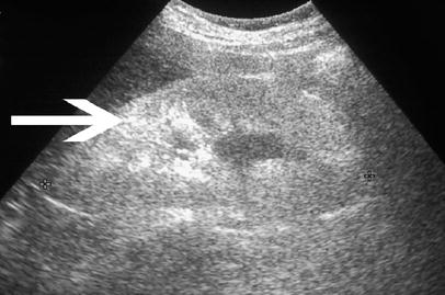 Imaging of acute pyelonephritis in the adult | SpringerLink