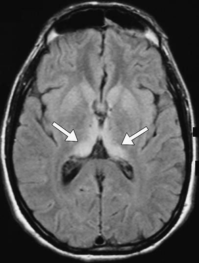 Radiological assessment of Creutzfeldt-Jakob disease | SpringerLink