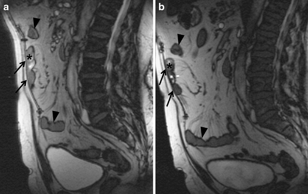 Functional cine MRI of the abdomen for the assessment of implanted ...