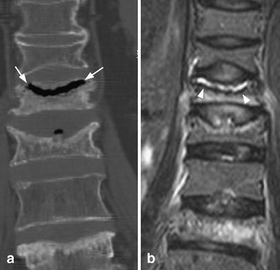 The intravertebral vacuum phenomen as specific sign of osteonecrosis in ...