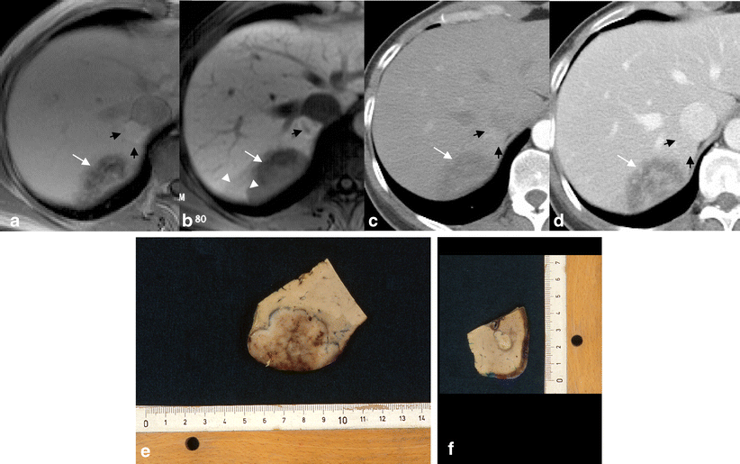 Diagnostic efficacy of gadoxetic acid (Primovist)-enhanced MRI and ...