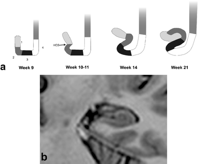 Incomplete inversion of the hippocampus—a common developmental anomaly ...