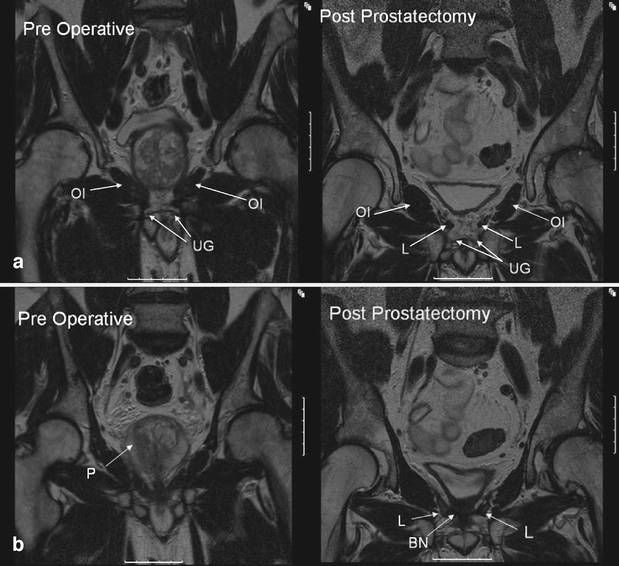 The normal post-surgical anatomy of the male pelvis following radical ...