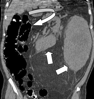 CT colonography with reduced bowel preparation after incomplete ...