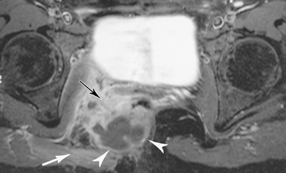Tailgut cysts: MRI findings | SpringerLink