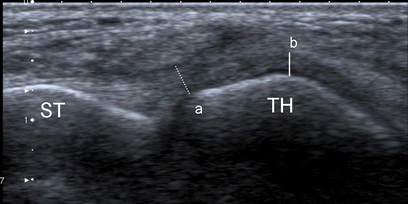 Ultrasound assessment of the spring ligament complex | SpringerLink
