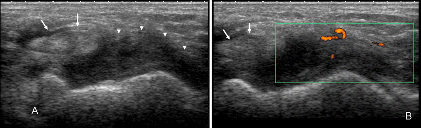 Ultrasound assessment of the spring ligament complex | SpringerLink