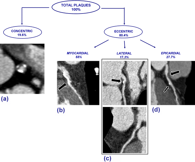 Coronary artery plaque formation at coronary CT angiography ...