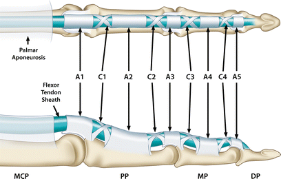Ultrasound-guided percutaneous release of the annular pulley in trigger ...