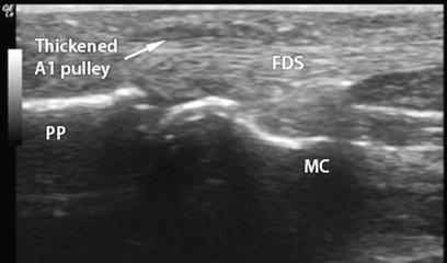 Ultrasound-guided percutaneous release of the annular pulley in trigger ...