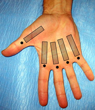 Ultrasound-guided percutaneous release of the annular pulley in trigger ...