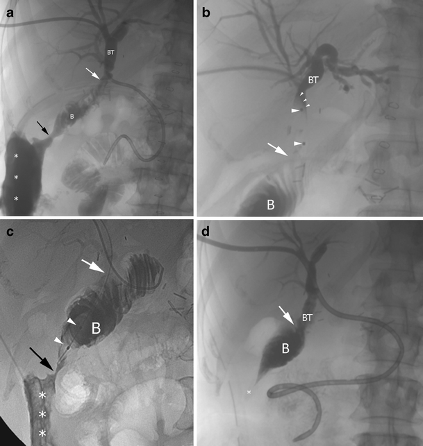 Management of post-surgical biliary leakage with percutaneous ...