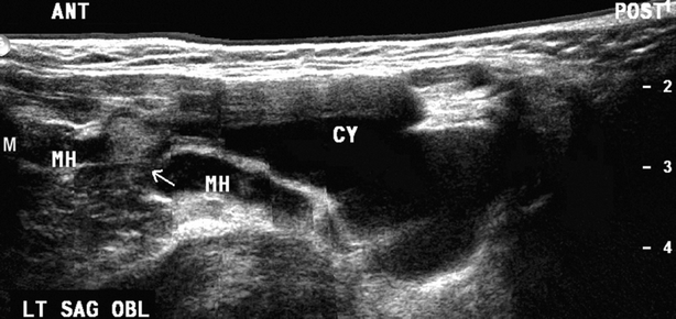 Plunging ranulas: high-resolution ultrasound for diagnosis and surgical ...