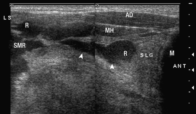Plunging ranulas: high-resolution ultrasound for diagnosis and surgical ...