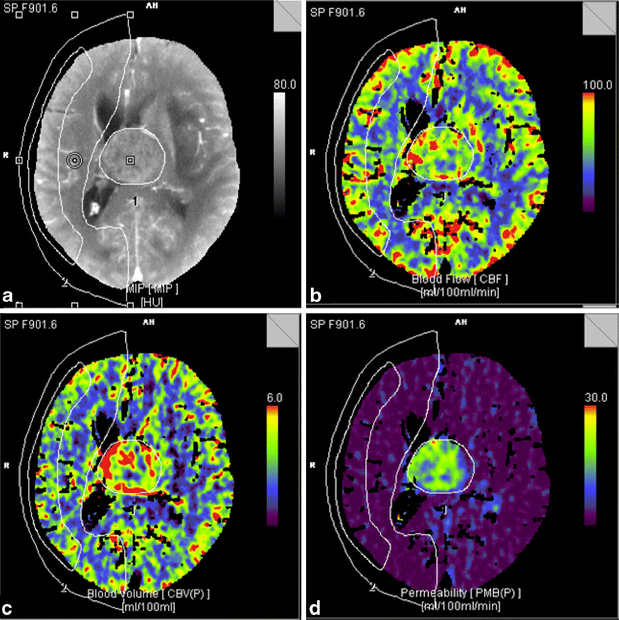Dynamic CT perfusion imaging of intra-axial brain tumours: differentiation of high-grade gliomas ...