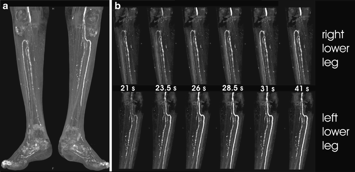 Diagnostic value of time-resolved CT angiography for the lower leg ...