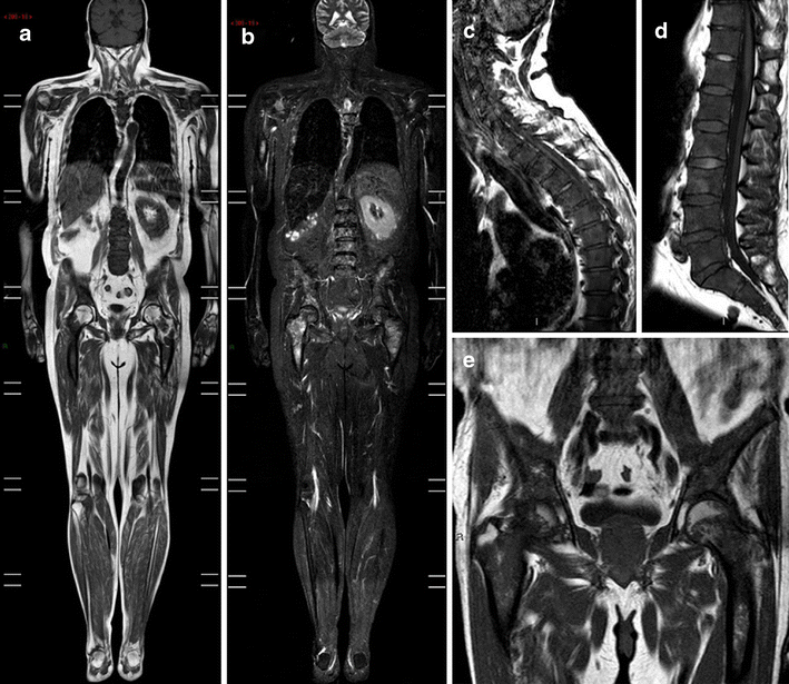 Whole-body MRI (WB-MRI) versus axial skeleton MRI (AS-MRI) to detect ...