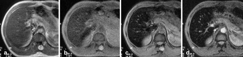 Liver iron concentration quantification by MRI: are recommended ...