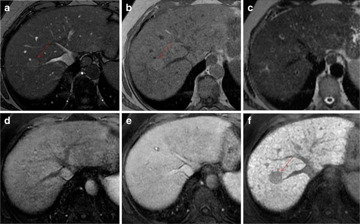 Contribution of the hepatobiliary phase of Gd-EOB-DTPA-enhanced MRI to ...