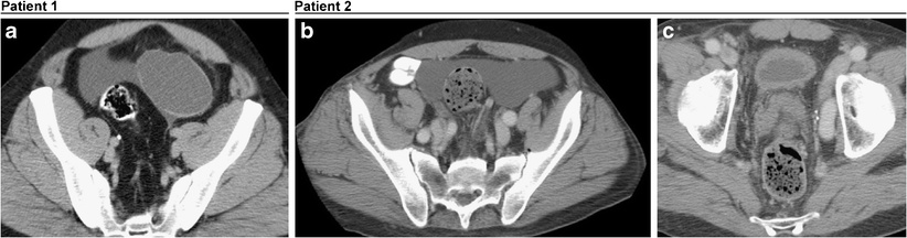 Peritoneal inclusion cysts: clinical characteristics and imaging ...