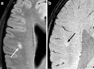 The “central vein sign”: is there a place for susceptibility weighted ...