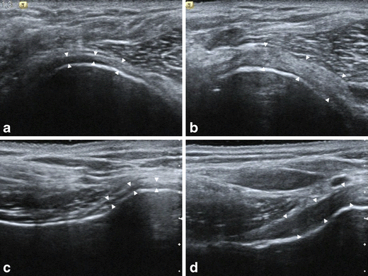 Thickening of the inferior glenohumeral capsule: an ultrasound sign for ...