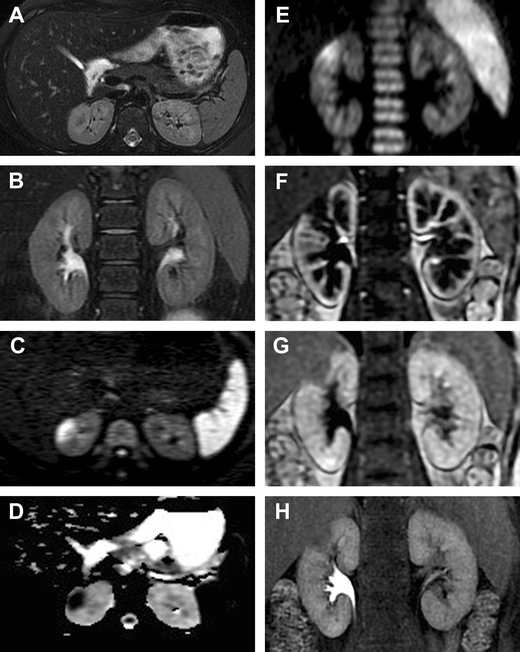 MRI and suspected acute pyelonephritis in children: comparison of ...