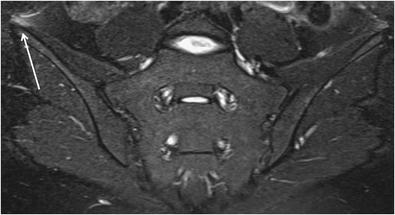 Diagnostic value of pelvic enthesitis on MRI of the sacroiliac joints ...