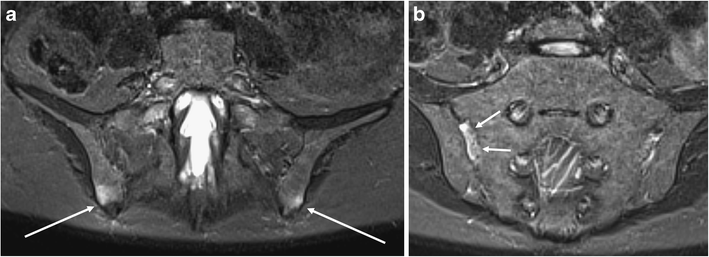 Diagnostic value of pelvic enthesitis on MRI of the sacroiliac joints ...