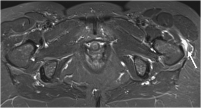 Diagnostic value of pelvic enthesitis on MRI of the sacroiliac joints ...