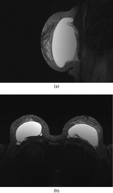 MRI screening for silicone breast implant rupture: accuracy, inter- and ...