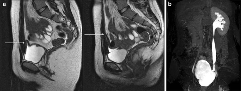 Clinical value of magnetic resonance imaging in patients with Mayer ...