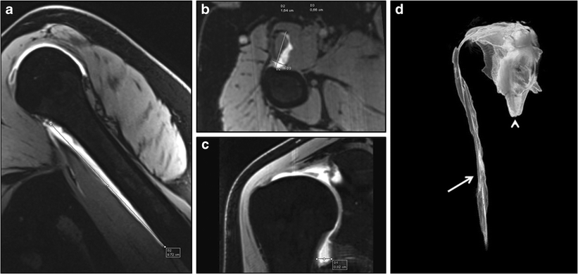Extra-articular contrast material leaks into locations unrelated to the ...