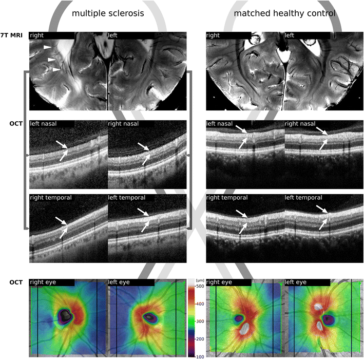 Optic radiation damage in multiple sclerosis is associated with visual ...