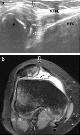 Evaluation of medial patellofemoral ligament tears after acute lateral ...